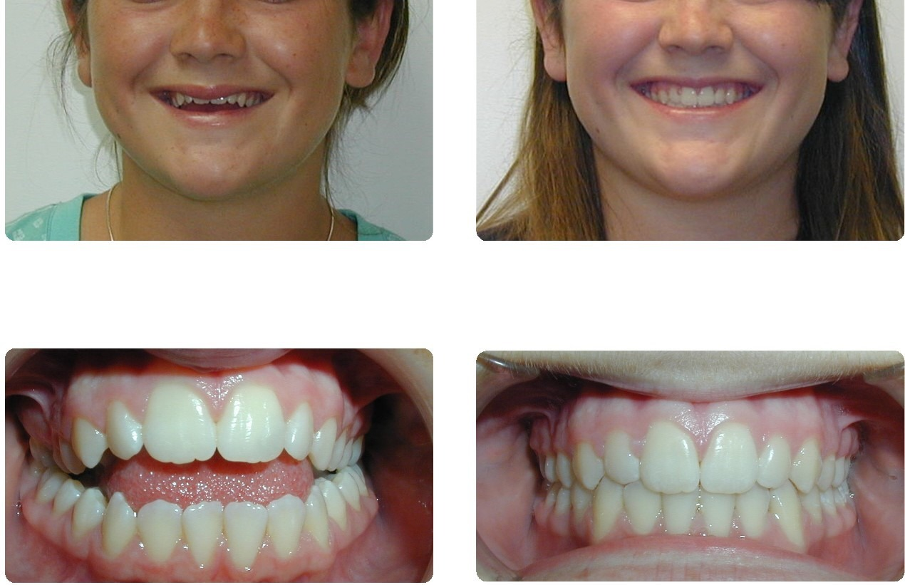 Open Bite How To Fix An Open Bite Naturally In Adults Before After Open Bite How To Fix An Open Bite Naturally In Adults Before After